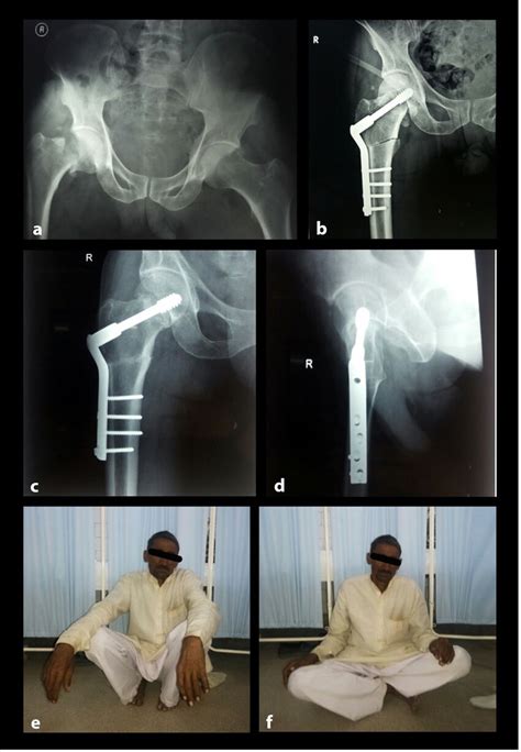 Clinical Case Of The Valgus Hip Osteotomy And Operative Fixation