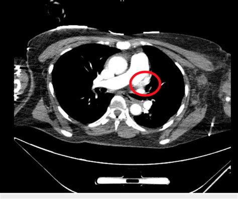 Computed Tomography Angiogram Shows A Large Filling Defect In The Main Download Scientific