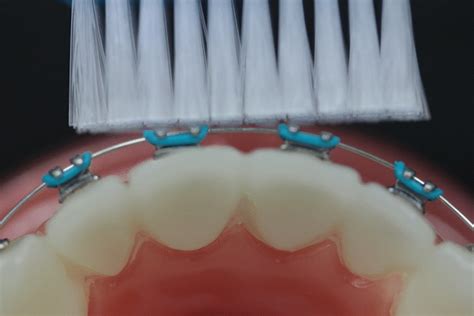 Keeping Braces Clean · Kingston Nj