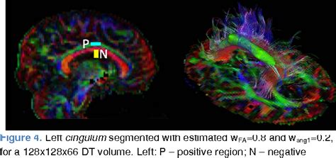Figure 4 From Improving Diffusion Tensor Imaging Segmentation Through An Adaptive Distance