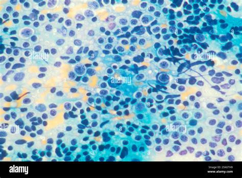 Lymphocytic Thyroiditis Light Micrograph Of A Section Through A