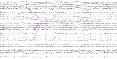 Lambda Is A Benign Variant Seen In Eeg Recordings With A Positive Polarity And Frequency Of 4