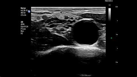 Philips Flash Ultrasound System 5100 Point Of Care