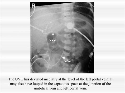 Neonatal Umbilical Venous Catherization Radiology Ppt
