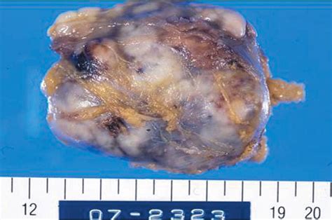 Extraskeletal Osteosarcoma With Partial Spontaneous Regression