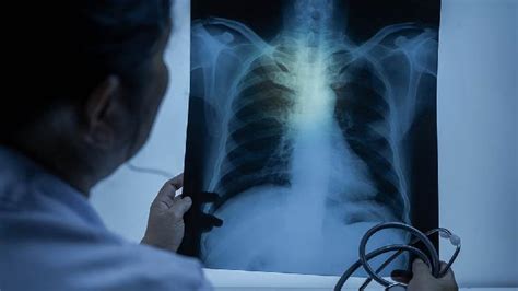 Perbedaan Gejala Pneumonia Bakteri Dengan Pneumonia Virus