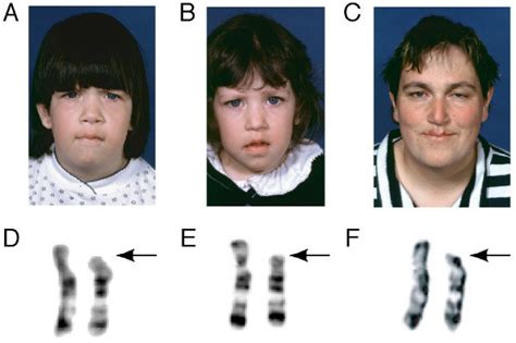 Chromosome Deletion Disorders