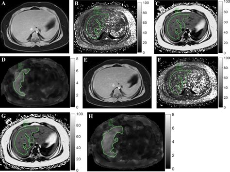 Cse Mri Sequence Images From A Representative Patient Obtained With