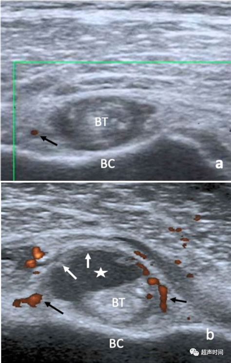肱二头肌断裂超声描述肱二头肌和肱三头肌大山谷图库