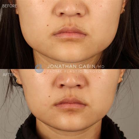 Non Surgical Procedures Before And Afters Dr Jonathan Cabin
