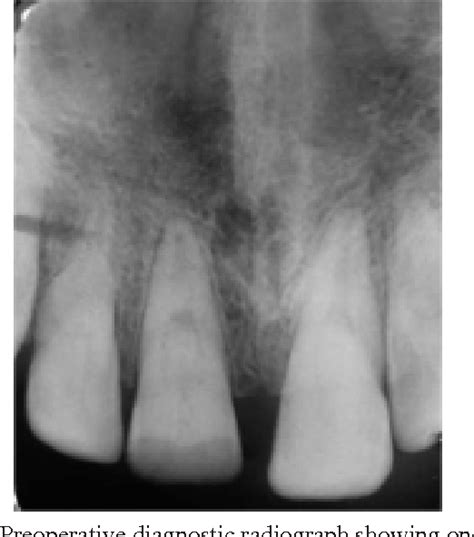 Figure 1 From Endodontic Treatment Of A Maxillary Central Incisor With Three Root Canals