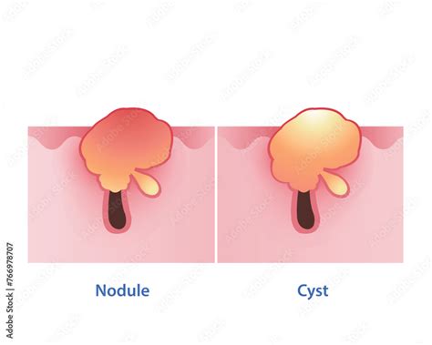 The Difference Between Nodule And Cyst Vector On White Background Nodular Is Firm Painful Red