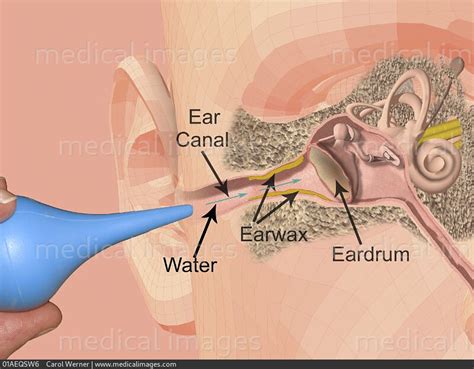 Stock Image Illustration Of The Ear An Ear Syringe Being Used To