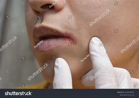 Angular Stomatitis