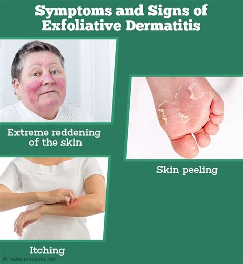 Exfoliative Dermatitis Causes Prevention Symptoms