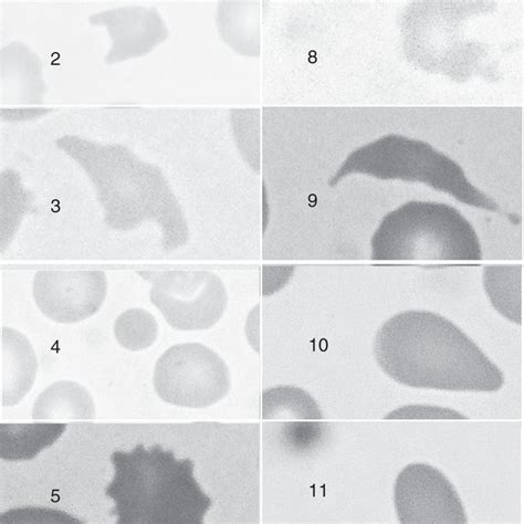 Types Of Schistocytes Present In The Circulated Blood Slides 1