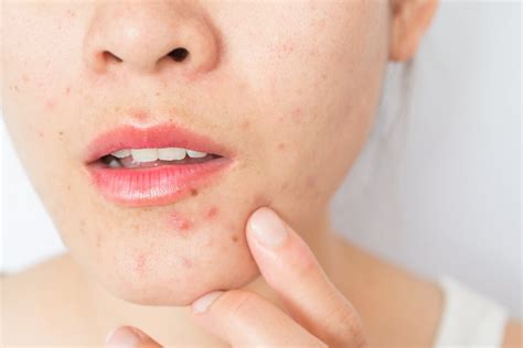 What Is Perioral Dermatitis 2 Dermatologists Explain Ps Beauty