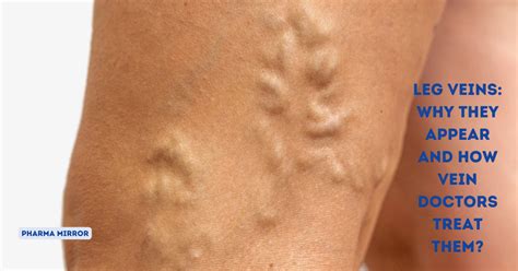 Pictures Of A Blown Vein In Leg The Tube