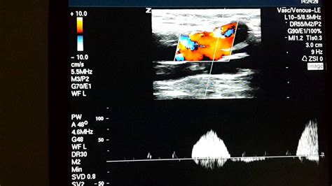 Incompetent Perforating Vein Cockett Youtube