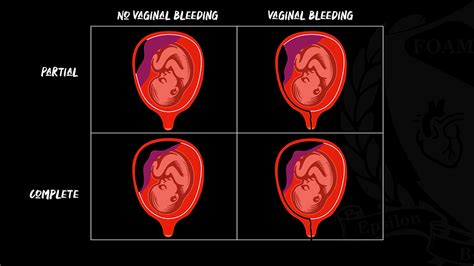 Placental Abruption
