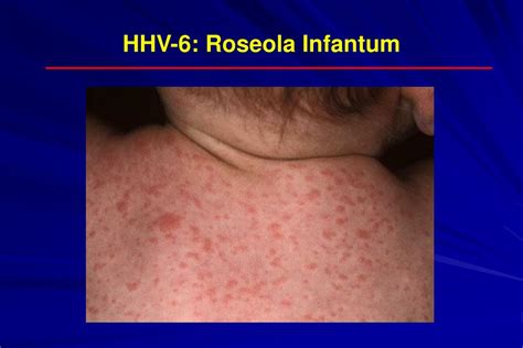 Ppt Herpesviridae 1 Powerpoint Presentation Free Download Id6775459