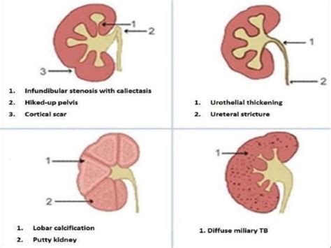 Genitourinary Tuberculosis 2020 Pptx Digestive Disorders Diseases And Conditions