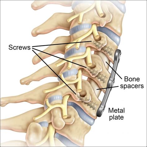 Cervical Fusion Spine And Orthopedic Specialists Neo Surgical Group