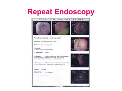 Post Operative Gastro Jejunostomy Efferent Loop Obstruction Due To Recurrent Ulcer With