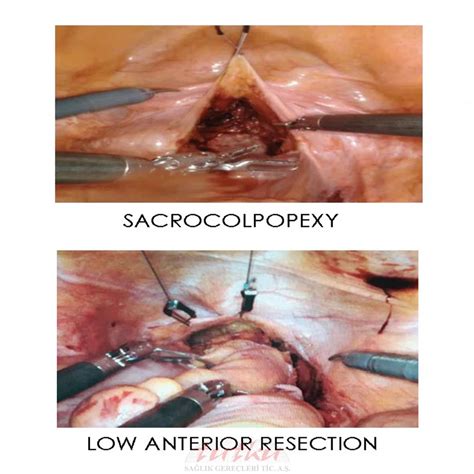 Versa Lifter Needle Port Free Internal Retractors Disposable