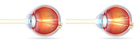 Astigmatisme Uz Leuven