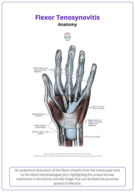 Pyogenic Flexor Tenosynovitis Anatomy Clinical View And Treatment