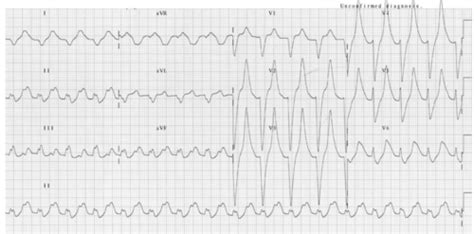Ekg Identification Flashcards Quizlet