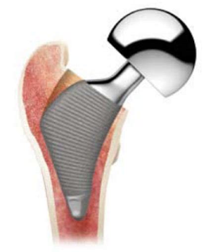 Proximal Femur Occupied By The Type 3 Short Stem Depuy Proxima