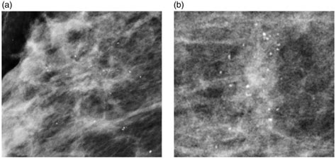 Regional Punctate Calcifications Classified As Bi Rads 3 The Final Download Scientific Diagram