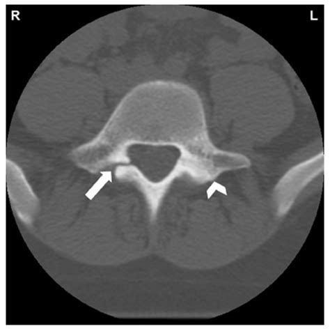 Pars Interarticularis Fractures Treated With Minimally Invasive Surgery A Literature Review