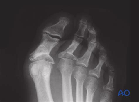 Lesser Toe Fractures
