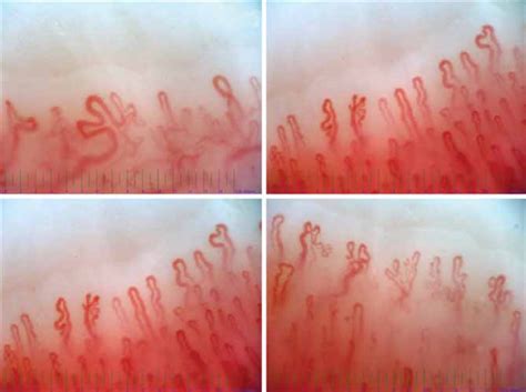 dermatomyositis anti jo1 and anti ro52 positive with scleroderma like download scientific