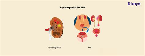 Pyelonephritis And Urinary Tract Infections Uti Knya
