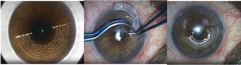 Case Report Of Corneal Allogenic Intrastromal Ring Segment Cairs In A