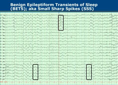 Eeg Registry Flashcards Quizlet