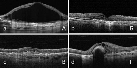 Structural Optical Coherence Tomography Scans Showing Representative Download Scientific