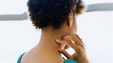 Seborrheic Dermatitis Dr Nokubonga Khoza