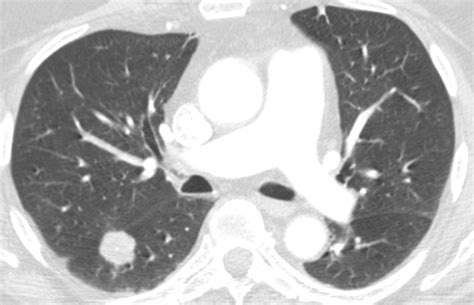 Calcified Granuloma In Lung
