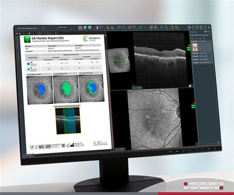Heidelberg Engineering On Linkedin Heidelbergappway Uncovermore Geographicatrophy Amd