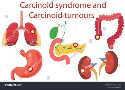 Carcinoid Syndrome Carcinoid Tumoursbowelsappendixstomach Pancreas Lung