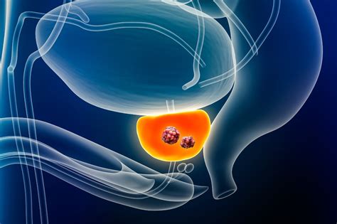 Ai Helps Predict Prostate Cancer Without Biopsy