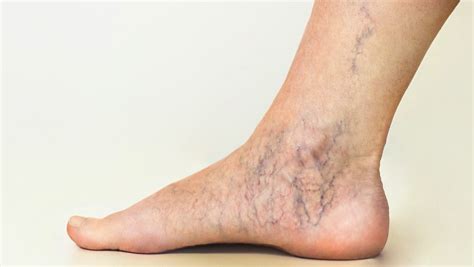 What Blue Veins Around Your Ankles Could Mean Vascular And Veins Care