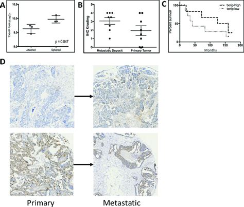 A Txnip Rna Isolated From Tumor Cells From Primary Ovarian Cancer
