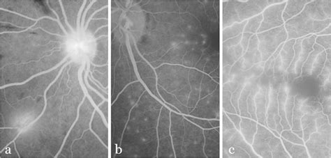 Classification Of Malarial Retinopathy Images Using Deep Learning By Samuel A Donkor Css