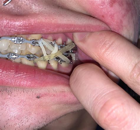 Class 2 And 3 Elastics At Same Time More In Comments R Braces